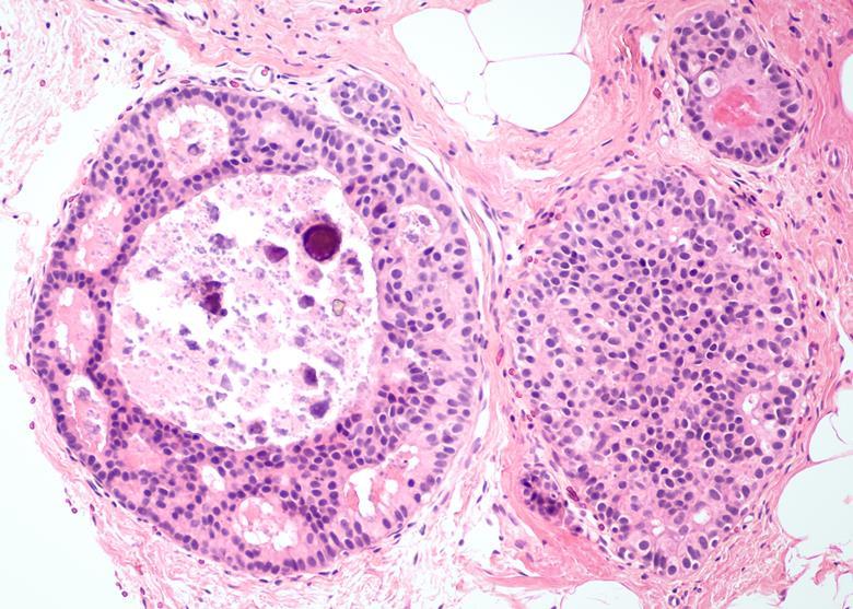 CIN gene score predicts breast cancer survival and immunotherapy ...