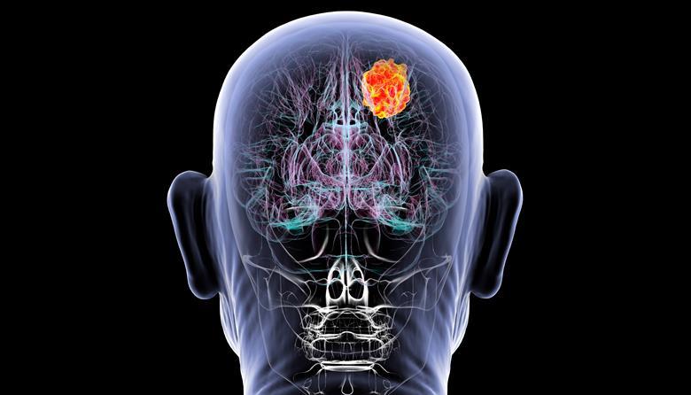 ATRX mutations reprogram epigenome in glioma, revealing new therapeutic ...